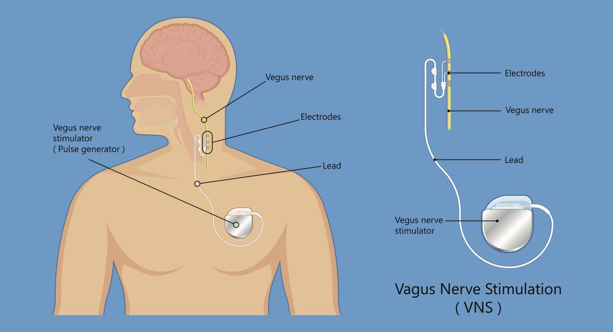 Vagus Nerve Stimulation Training - Momentum People